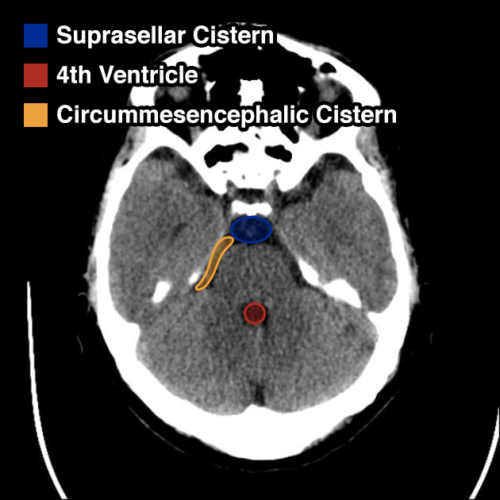 ct_head_0002_high_pons - Differential Diagnosis of
