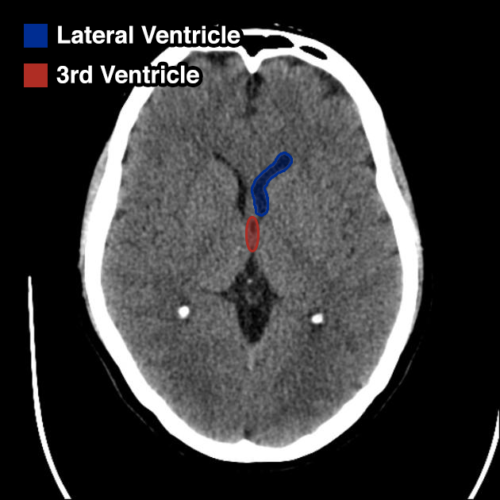 ct_head_0004_ventricles - Differential Diagnosis of
