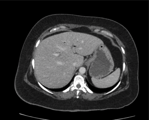 cyst-gastric_01 - Differential Diagnosis of