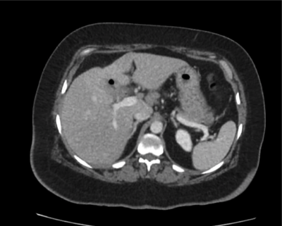 cyst-gastric_07 - Differential Diagnosis of