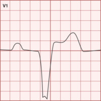 Left Bundle Branch Block (Part 1) - Differential Diagnosis of