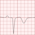 Pathologic Q-wave - Differential Diagnosis of