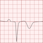 Pathologic Q-wave - Differential Diagnosis of