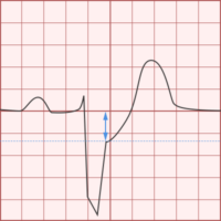 Differential Diagnosis of ECG Guide: Part II