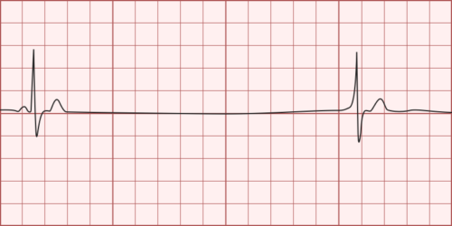Sinus Arrest - Differential Diagnosis of