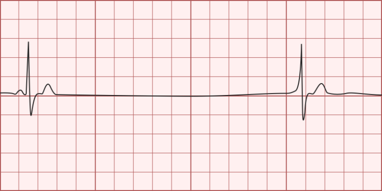Sinus Arrest - Differential Diagnosis of