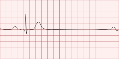 Sinus Bradycardia - Differential Diagnosis of