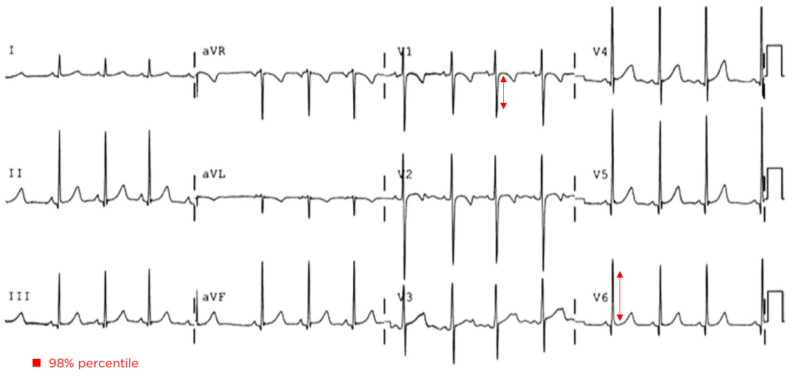 Differential Diagnosis of ECG Guide: Pediatrics