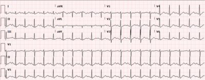 Differential Diagnosis of Sinus Tachycardia