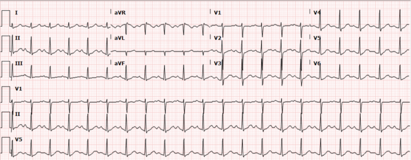 Differential Diagnosis of Sinus Tachycardia