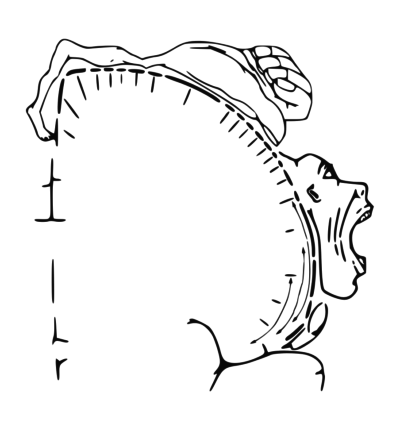 Homunculus - Differential Diagnosis of