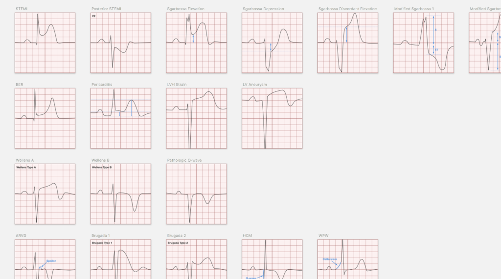 ecg - Differential Diagnosis of