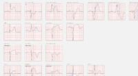 ecg - Differential Diagnosis of