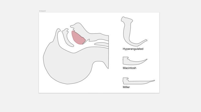 larynx - Differential Diagnosis of