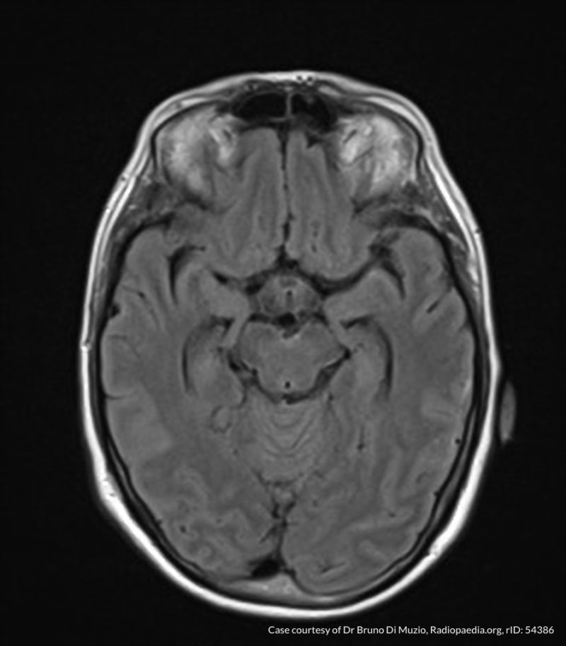 01_ventriculitis - Differential Diagnosis of