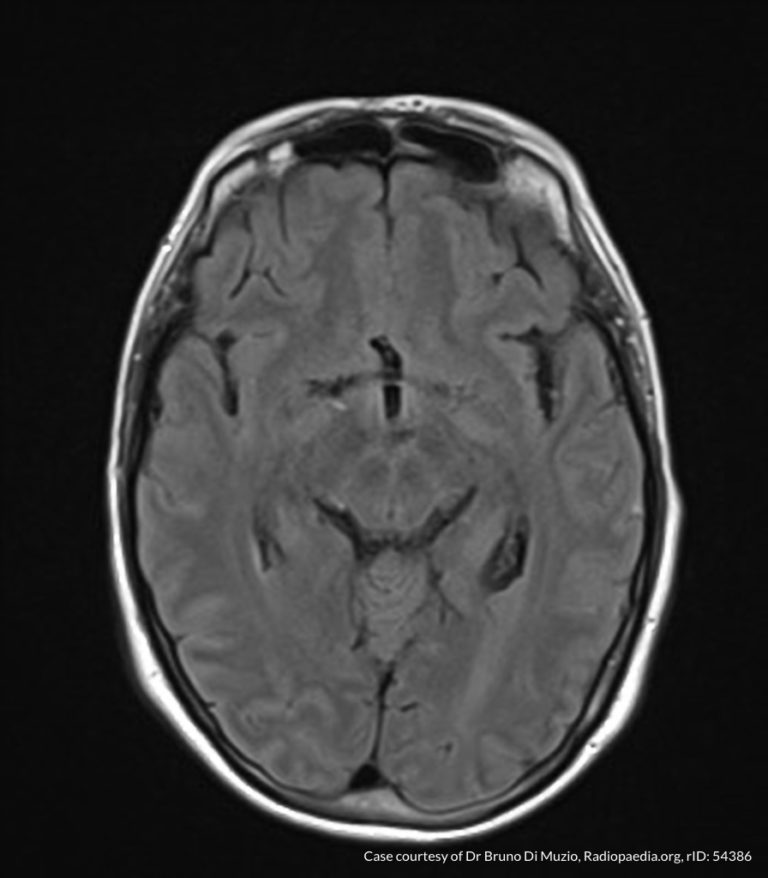02_ventriculitis - Differential Diagnosis of