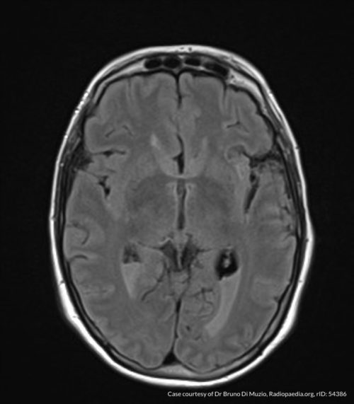 03_ventriculitis - Differential Diagnosis of