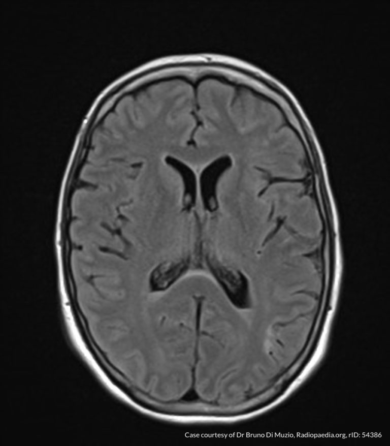 05_ventriculitis - Differential Diagnosis of