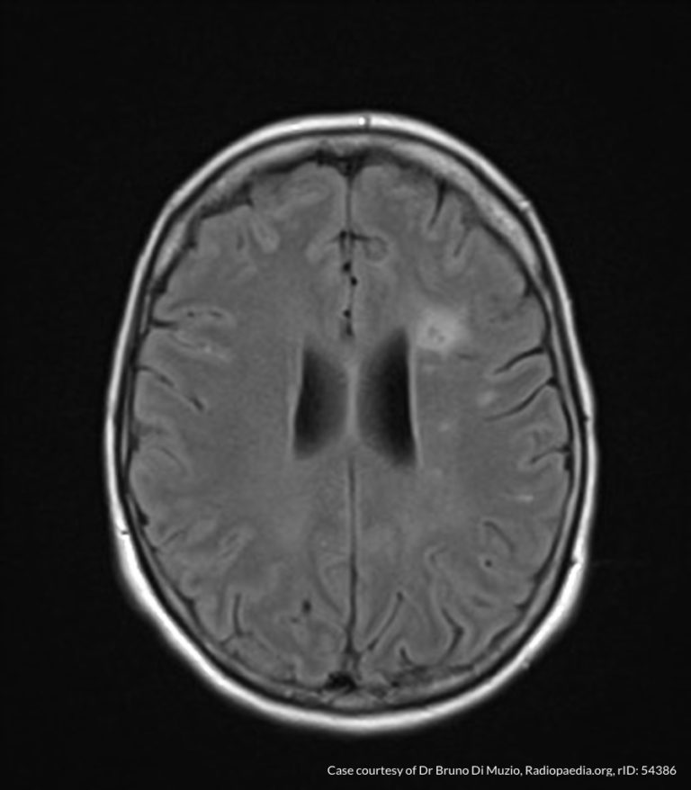 08_ventriculitis - Differential Diagnosis of