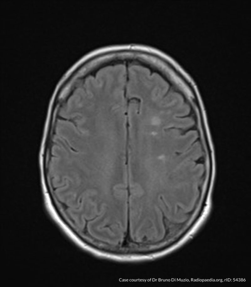 09_ventriculitis - Differential Diagnosis of