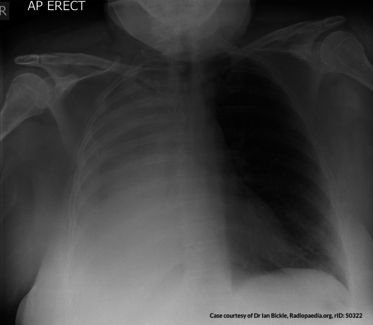 Pleural Effusion Tags - Differential Diagnosis of