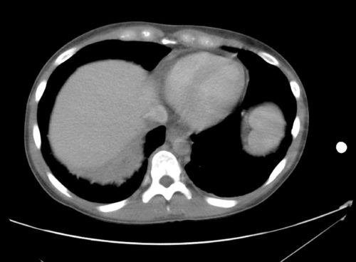 01_pyelo - Differential Diagnosis of