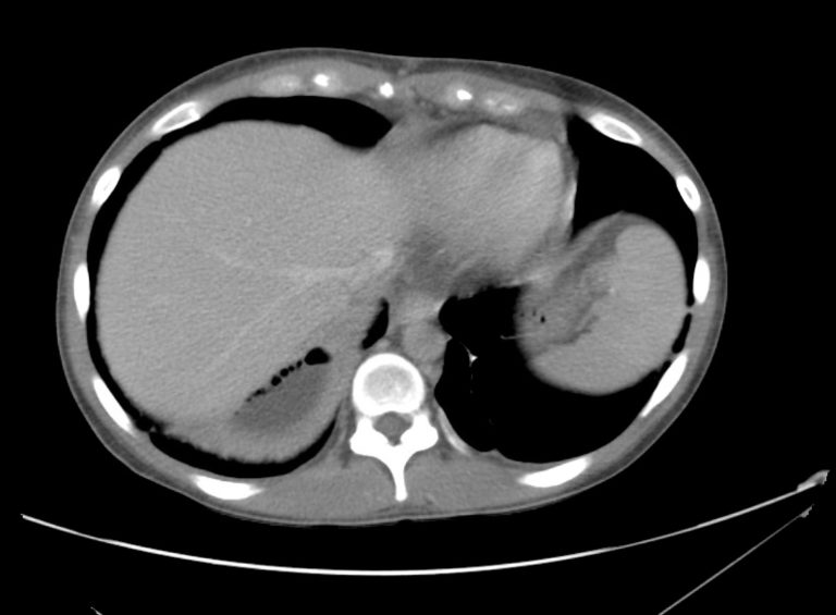 03_pyelo - Differential Diagnosis of