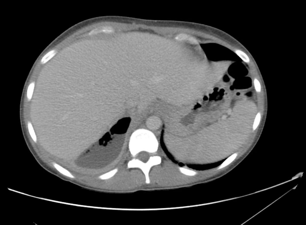05_pyelo - Differential Diagnosis of