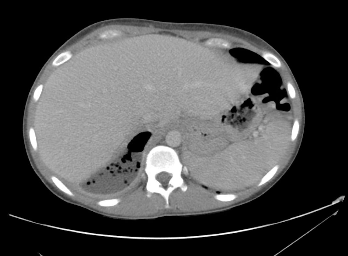 06_pyelo - Differential Diagnosis of