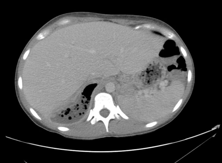 07_pyelo - Differential Diagnosis of