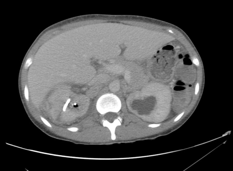 11_pyelo - Differential Diagnosis of