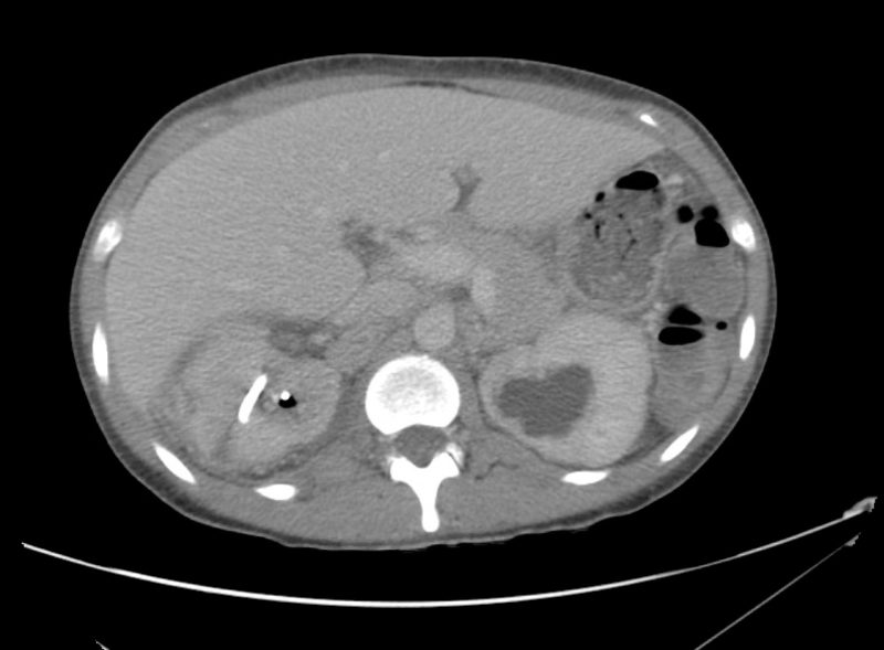 11_pyelo - Differential Diagnosis of