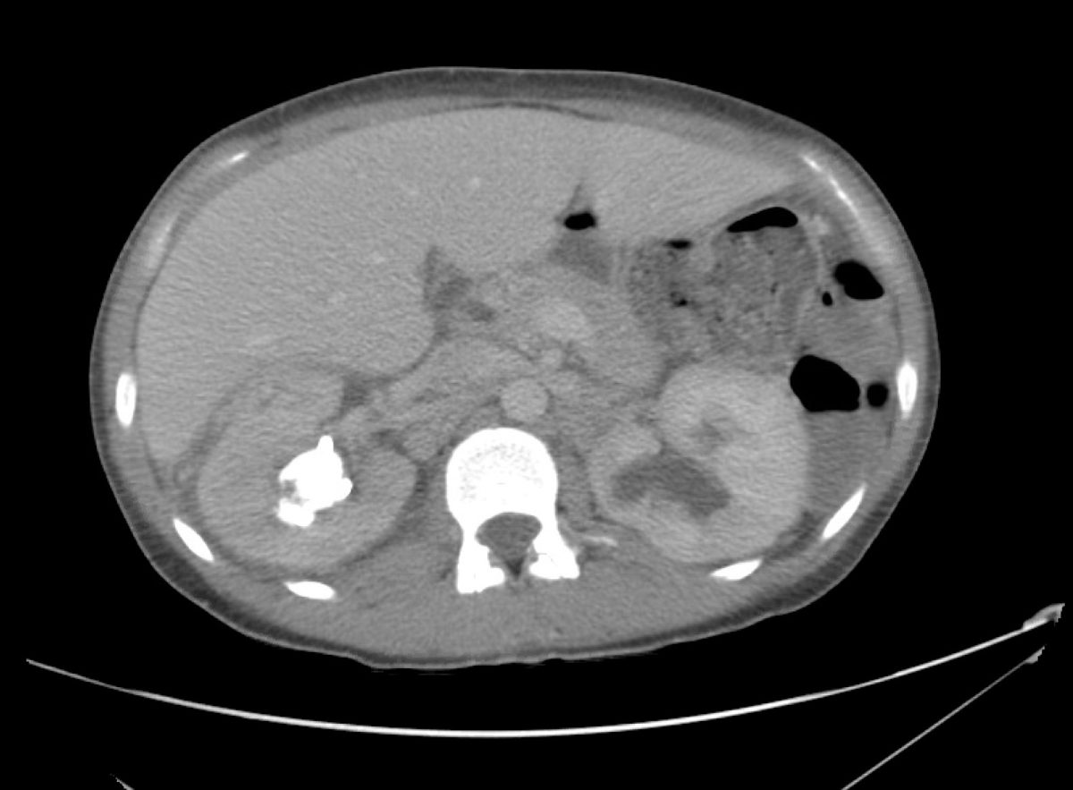 12_pyelo - Differential Diagnosis of