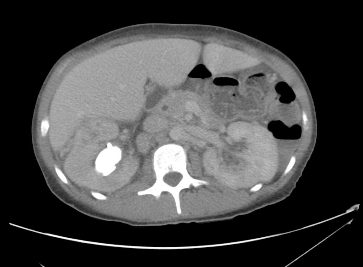 13_pyelo - Differential Diagnosis of