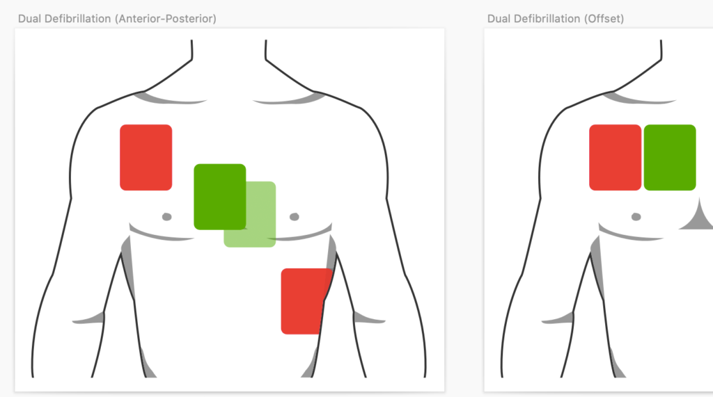 defibrillation - Differential Diagnosis of