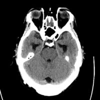 00_ct_csf_shunt - Differential Diagnosis of