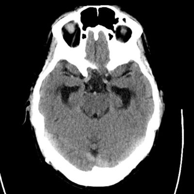 01_ct_csf_shunt - Differential Diagnosis of