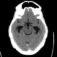 02_ct_csf_shunt - Differential Diagnosis of