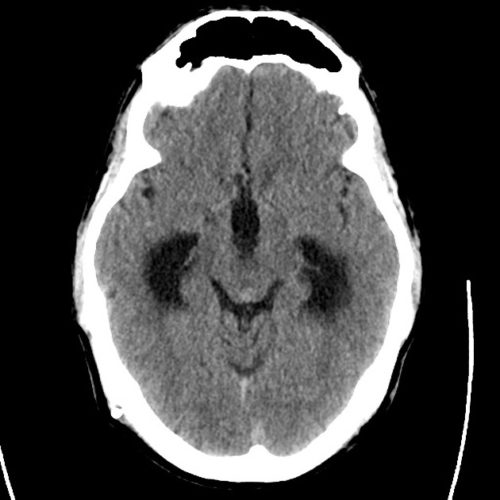03_ct_csf_shunt - Differential Diagnosis of