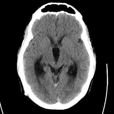 04_ct_csf_shunt - Differential Diagnosis of