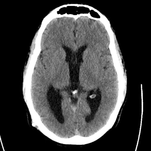 05_ct_csf_shunt - Differential Diagnosis of