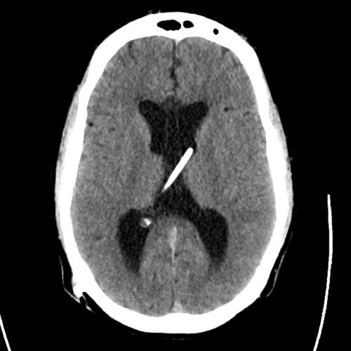 07_ct_csf_shunt - Differential Diagnosis of