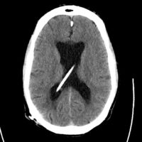 08_ct_csf_shunt - Differential Diagnosis of