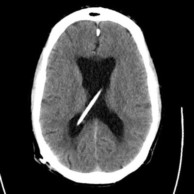 08_ct_csf_shunt - Differential Diagnosis of