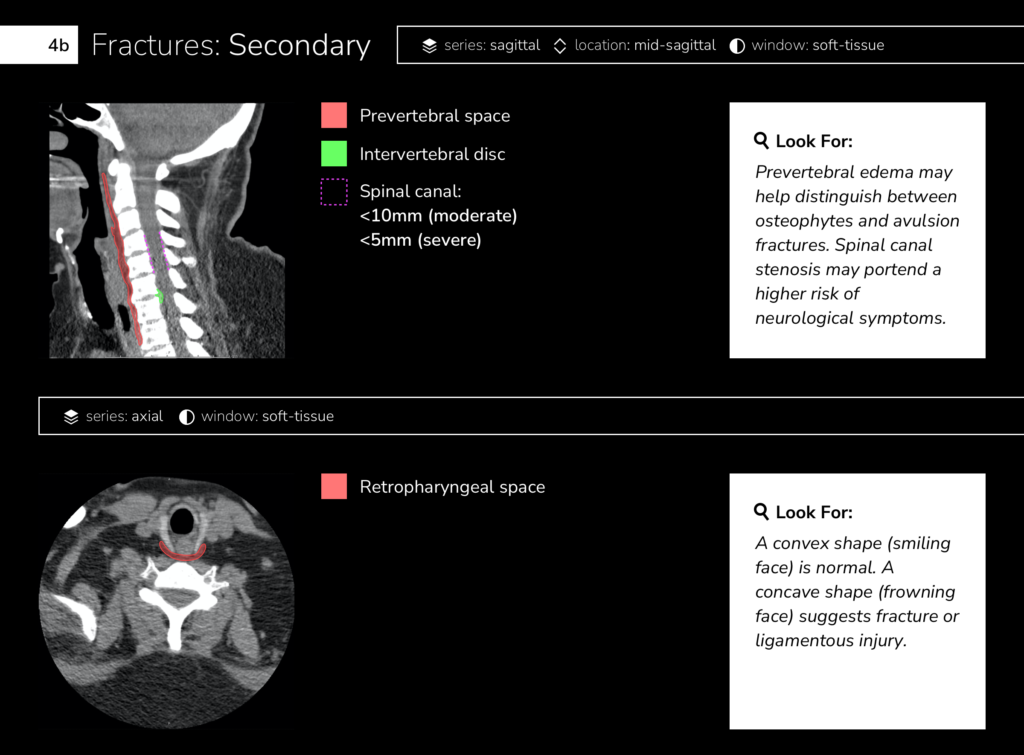 Differential Diagnosis of Infographic: CT Cervical Spine Interpretation