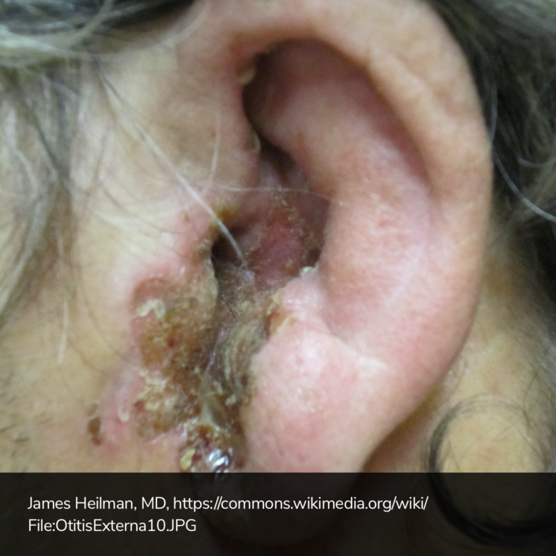 otitis_externa - Differential Diagnosis of
