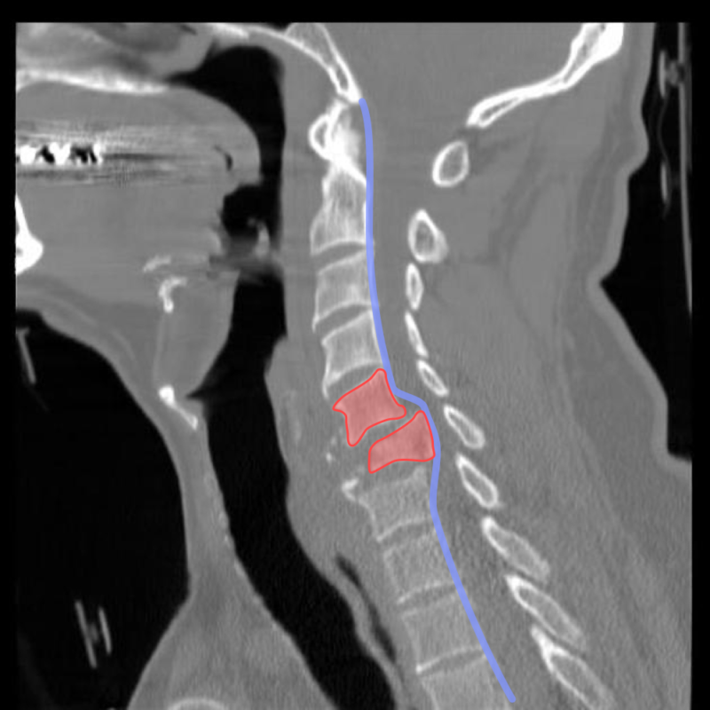 pathological_fracture - Differential Diagnosis of