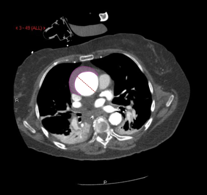 aortic_aneurysm - Differential Diagnosis of