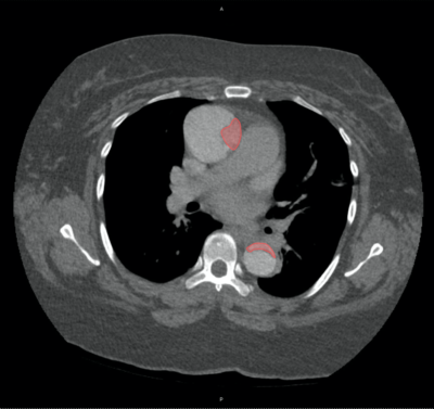 dissection_flap - Differential Diagnosis of