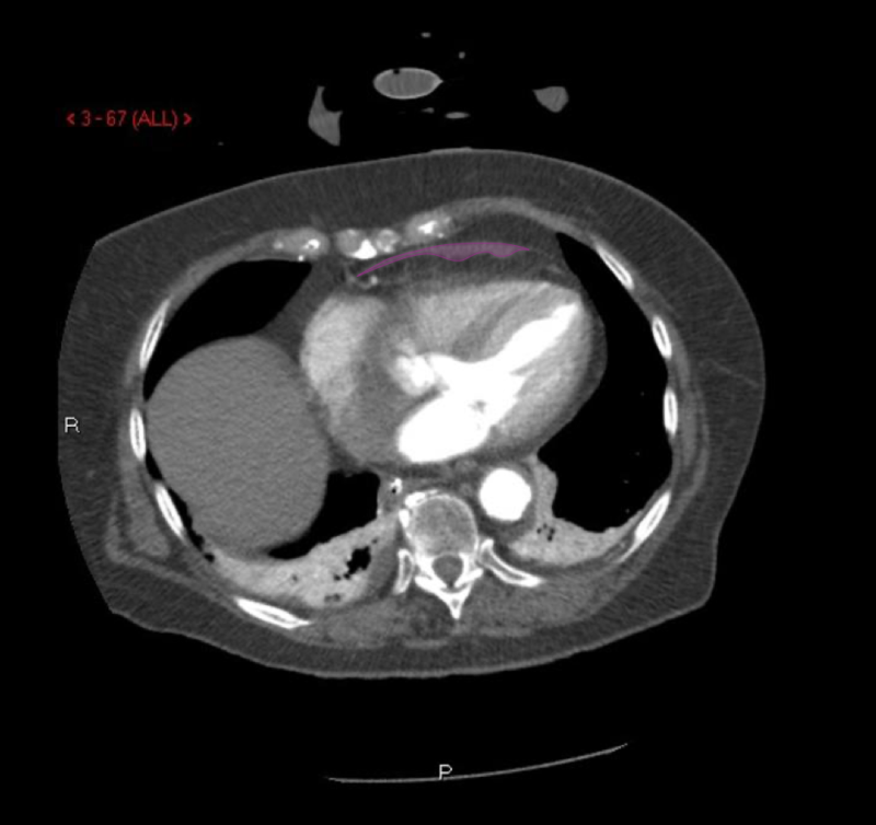 hemopericardium - Differential Diagnosis of